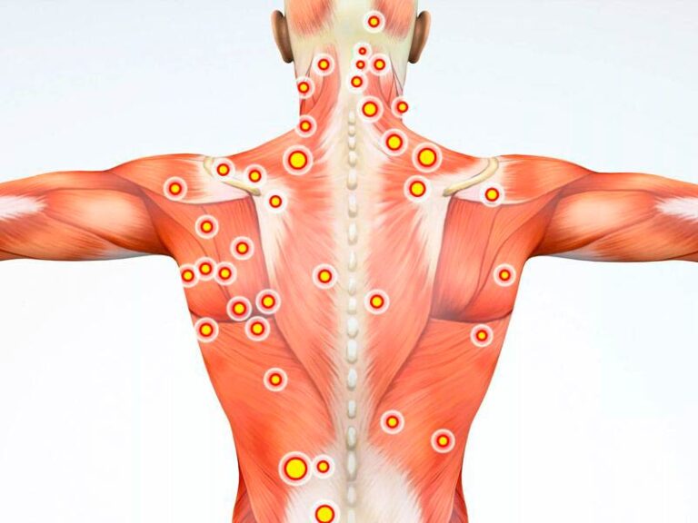 ¿Qué es la terapia de puntos gatillo y cómo puede aliviar su dolor?
